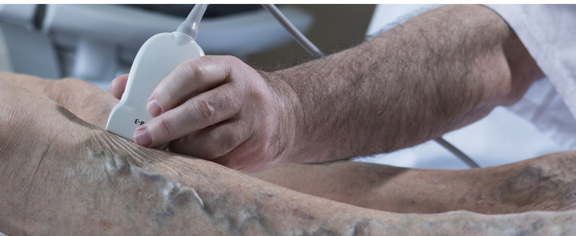 Krampfadern (Varizen) | Kreiskliniken Herford-Bünde
